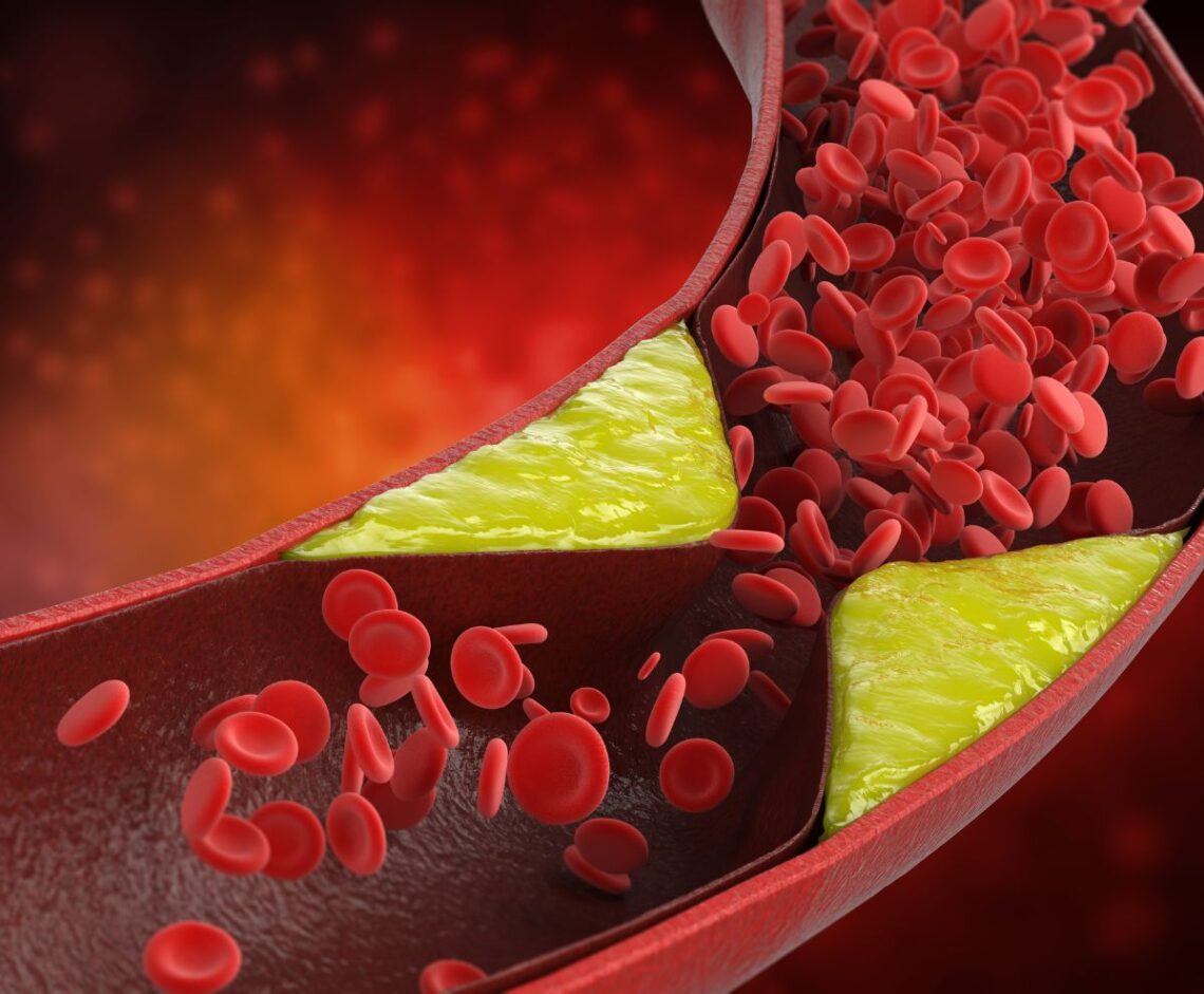 The Best Diet for Familial Hypercholesterolemia - Life Of a Hero