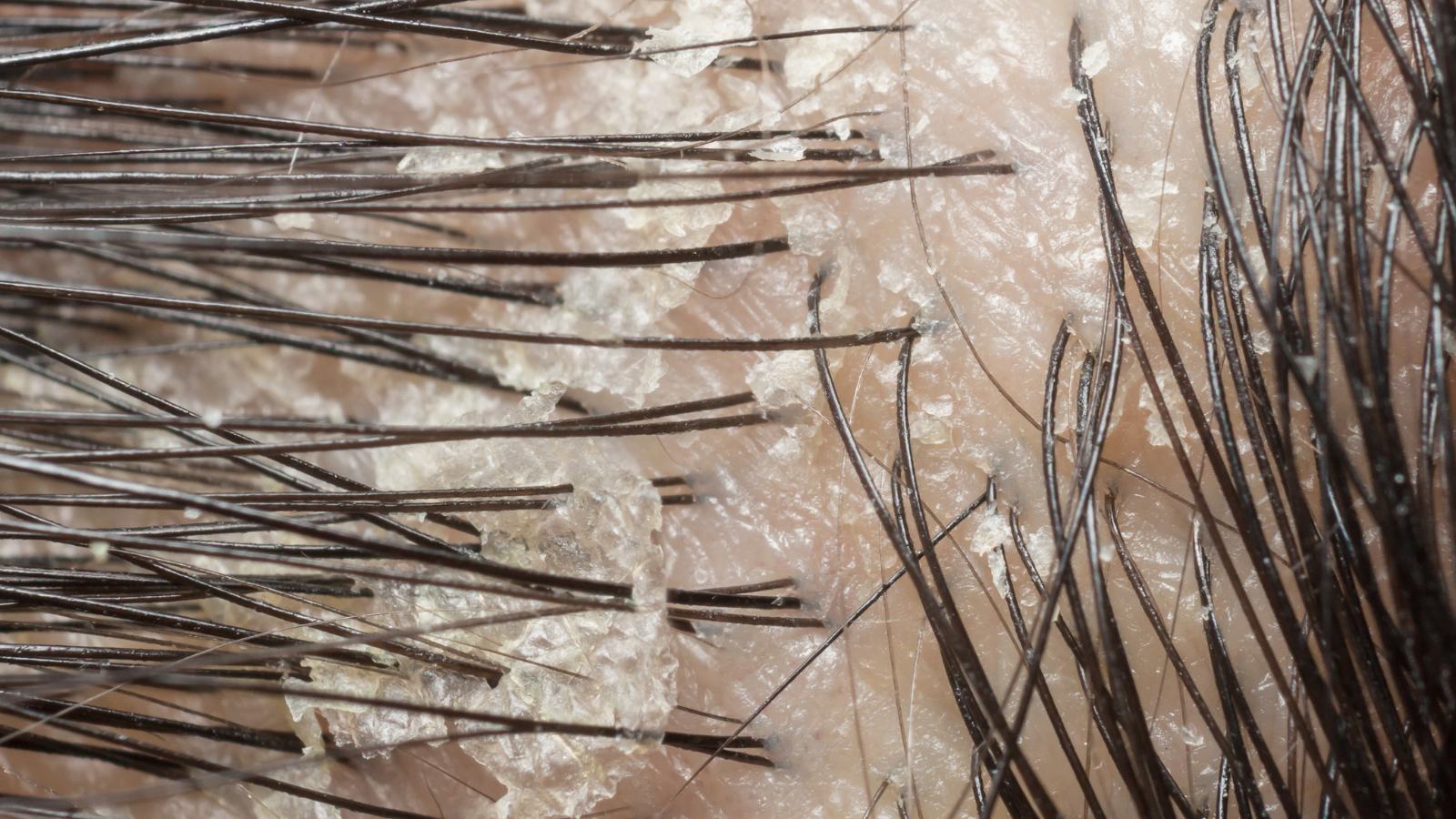 5 Steps to Conquer Dandruff: Insulin Resistance Revealed - Life Of a Hero